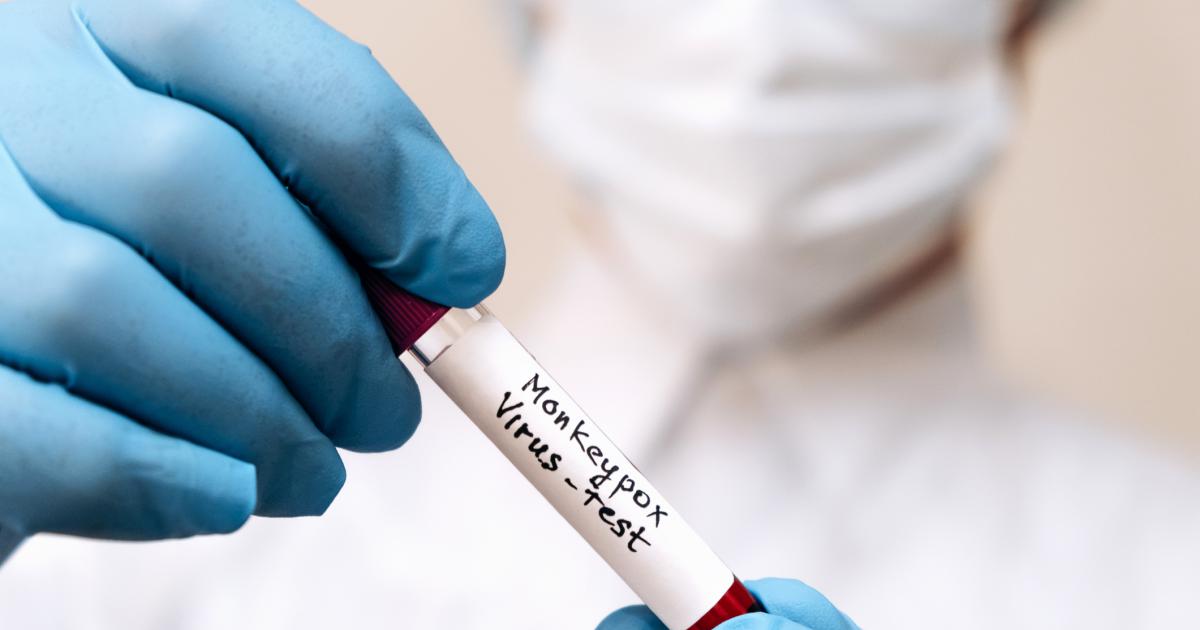 Eerste geval van Apenpokken in regio Aken | ZO-NWS